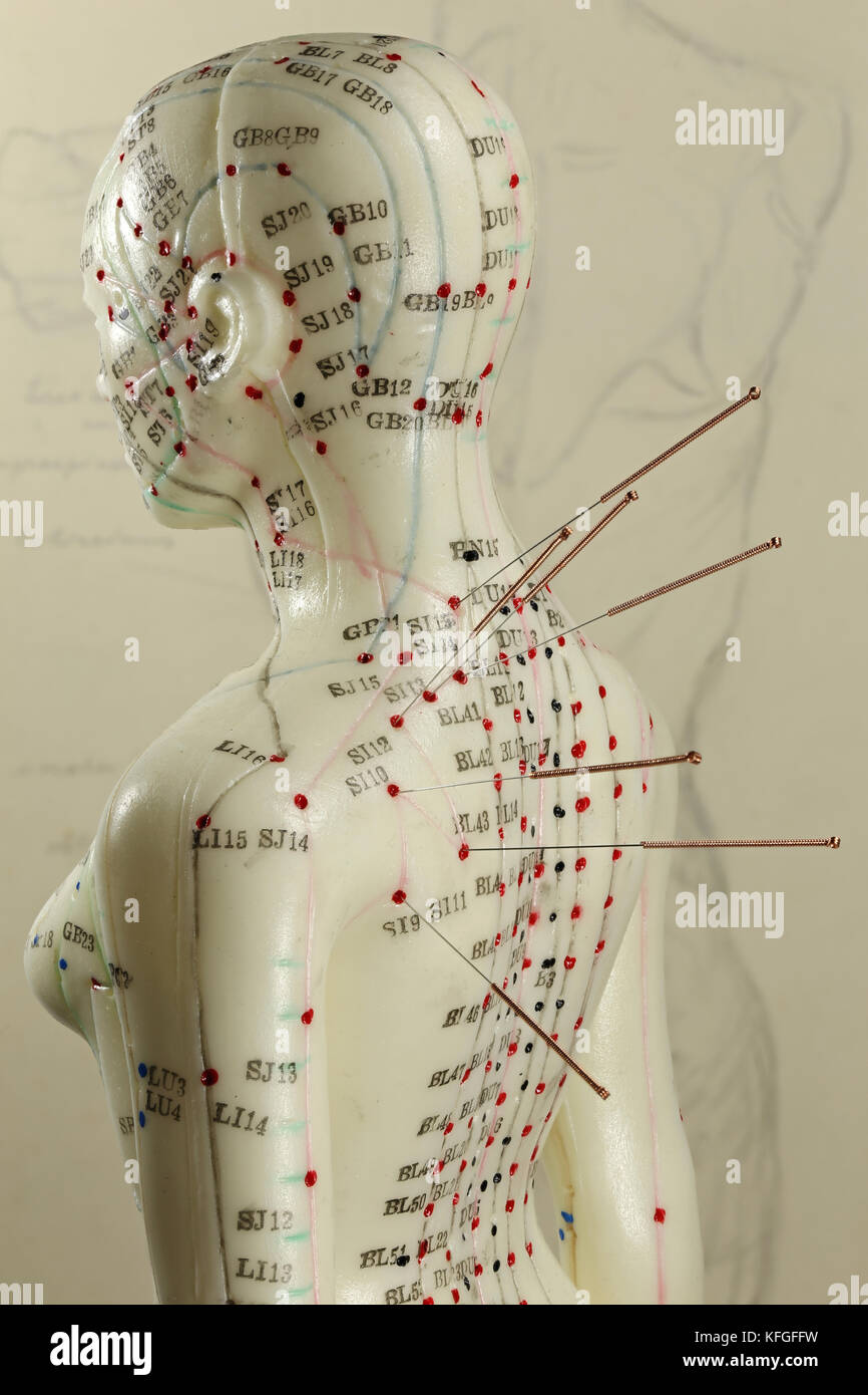 female acupuncture model with needles in the shoulder Stock Photo - Alamy