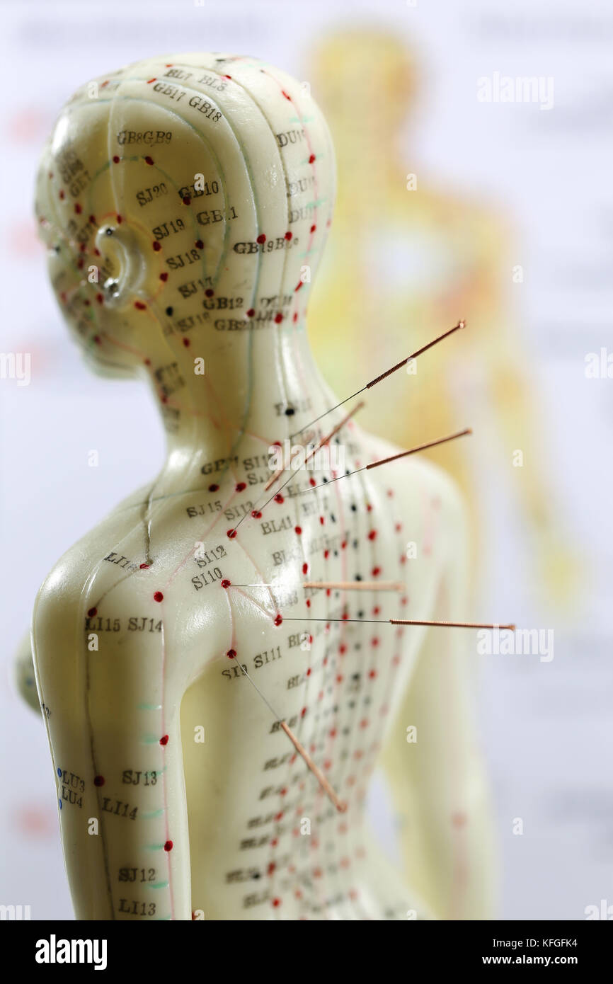 female acupuncture model with needles in the shoulder Stock Photo - Alamy