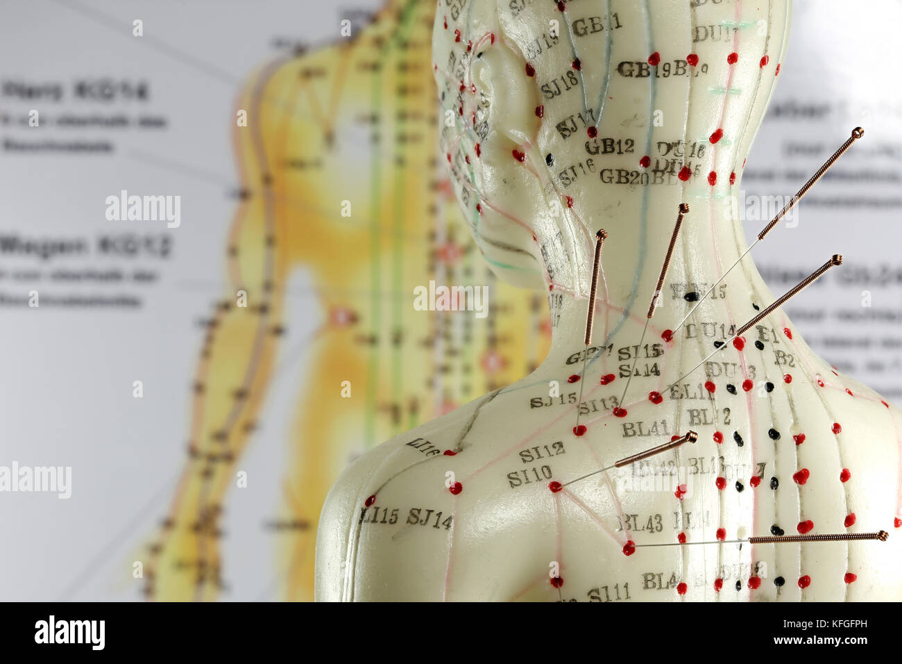 female acupuncture model with needles in the shoulder Stock Photo - Alamy