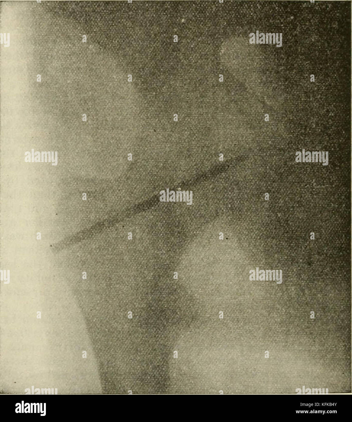 "Modern surgery, general and operative" (1919 Stock Photo - Alamy