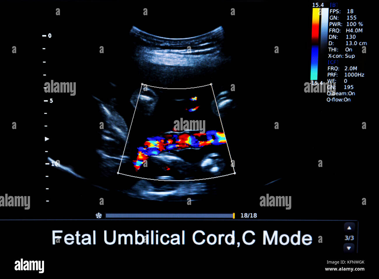 Colourful image of modern ultrasound monitor. Ultrasonography machine ...