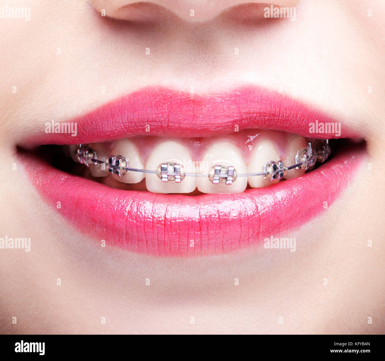 Closeup of woman open smiling mouth with pink lips and brackets Stock ...