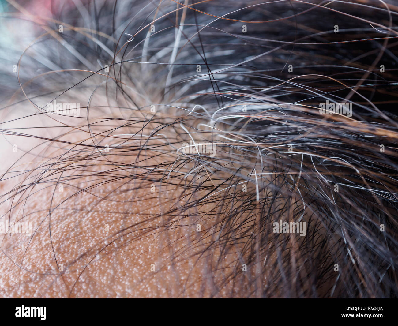 Hair problem hi-res stock photography and images - Alamy