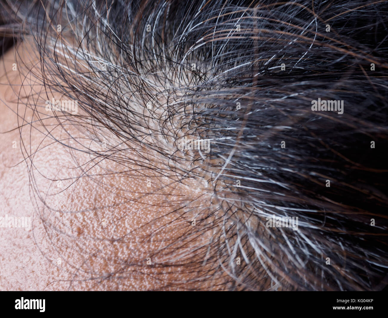 Hair problem hi-res stock photography and images - Alamy
