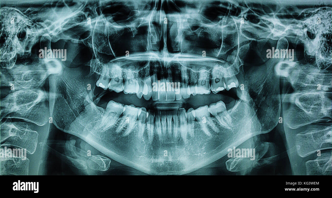 X ray of a womans mouth in 360 perspective Stock Photo - Alamy