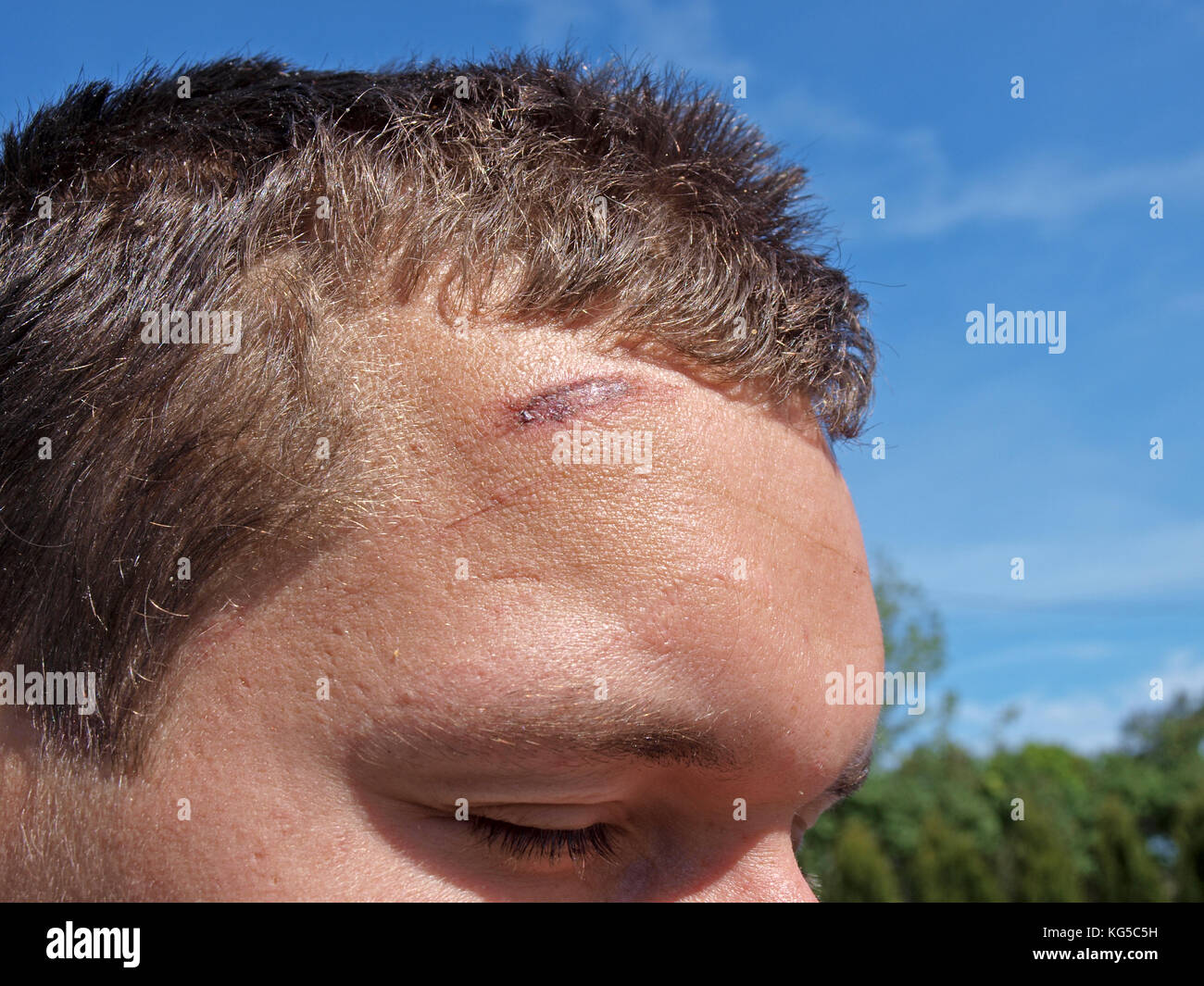 Young man with the wound on forehead close up Stock Photo - Alamy
