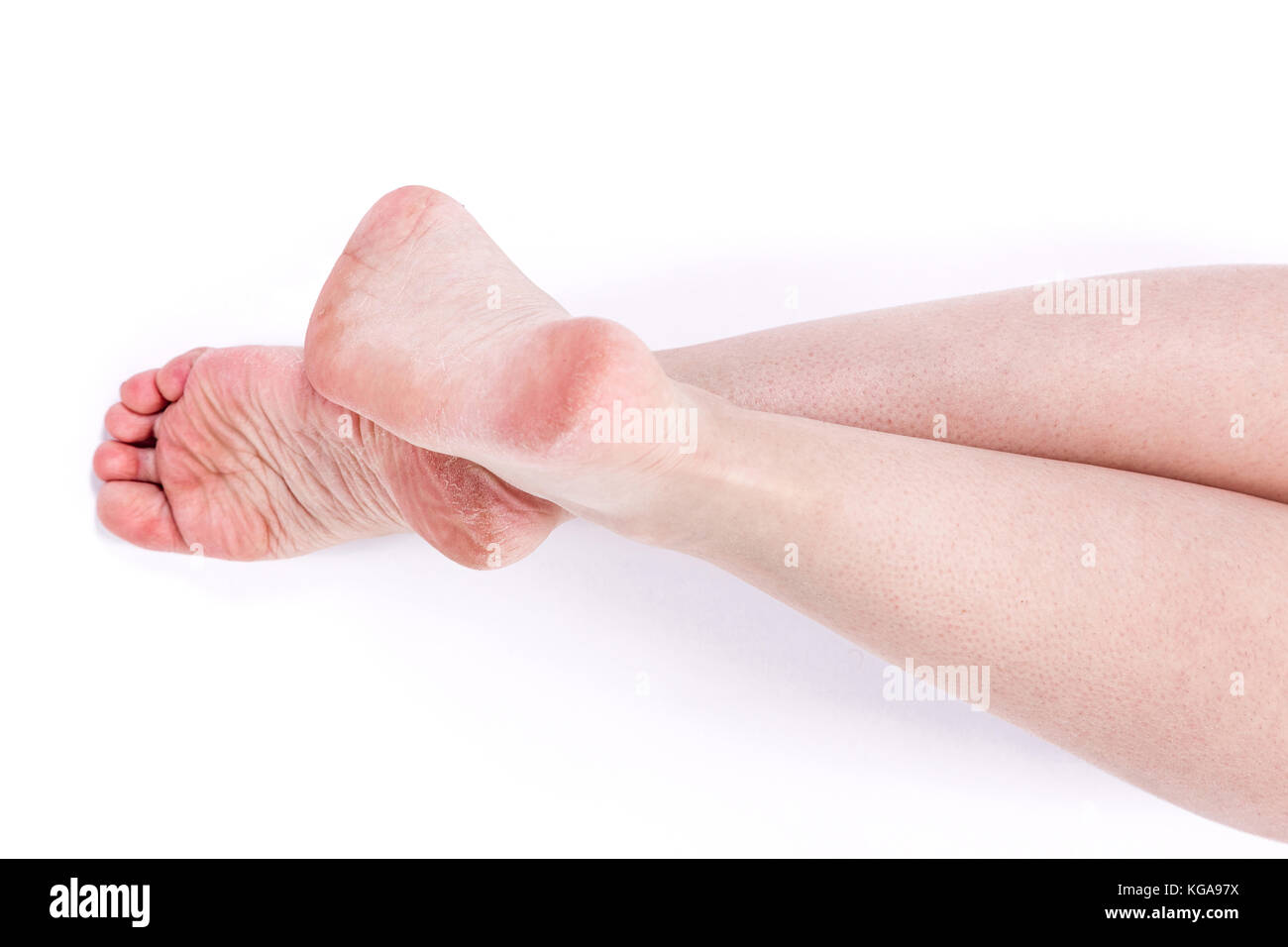 dry dehydrated skin on the heels of female feet with calluses Stock ...