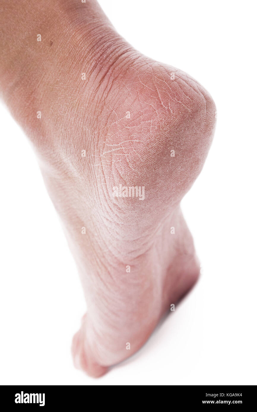 dehydrated skin on the heels of female feet Stock Photo - Alamy