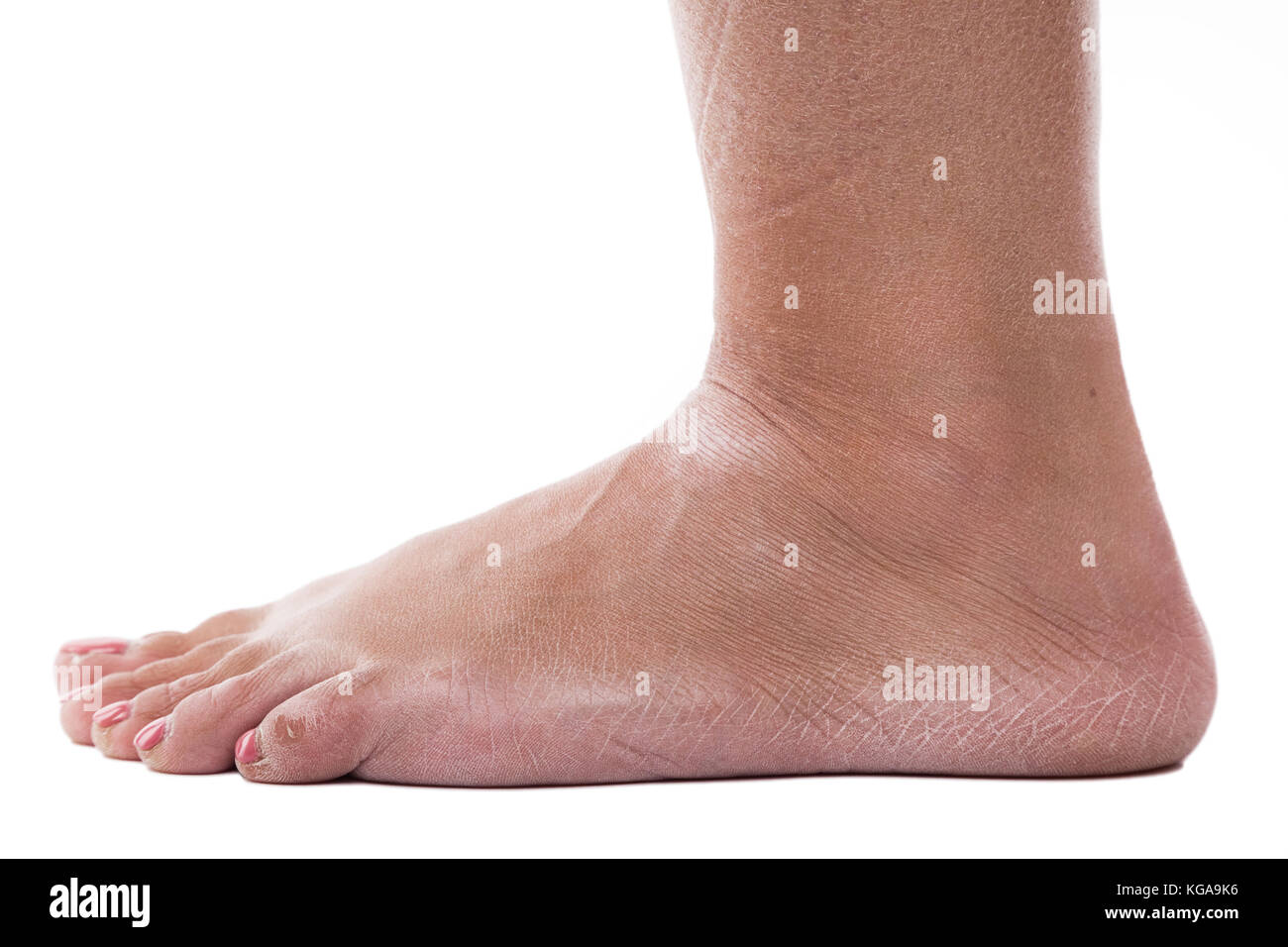 dehydrated skin on the heels of female feet Stock Photo - Alamy