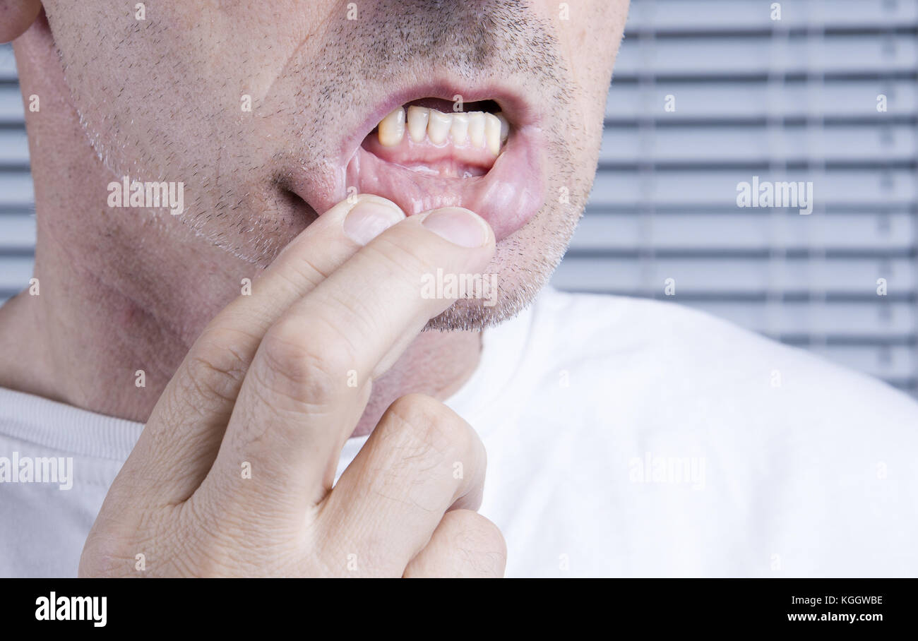 Closeup teeth, dental health care clinic with missing tooth Stock Photo ...