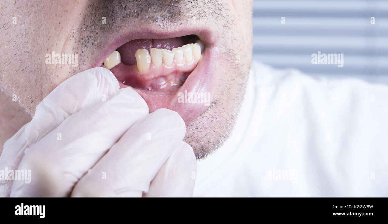 Missing teeth adult hi-res stock photography and images - Alamy