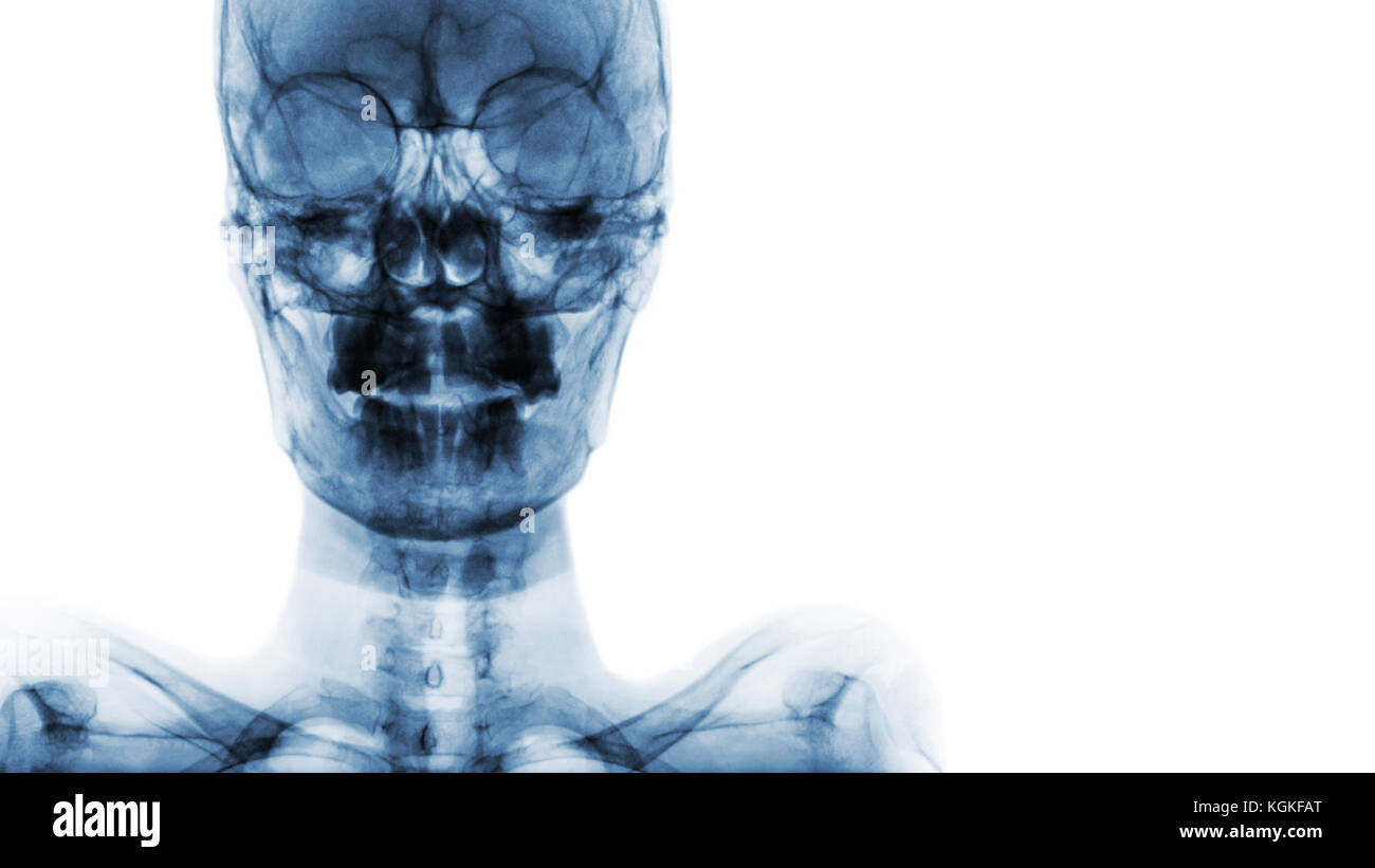 film x-ray Skull AP : show normal human's skull and blank area at right ...