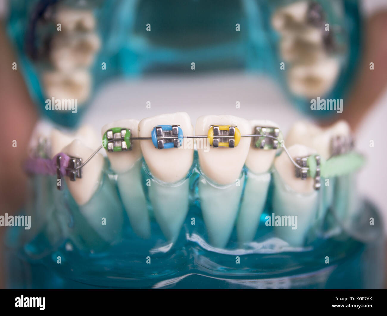 Denture for students with classic dental metal orthodontics. Color ...