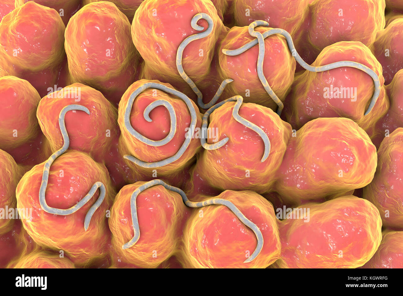 Threadworms in the gut. Computer illustration showing multiple ...