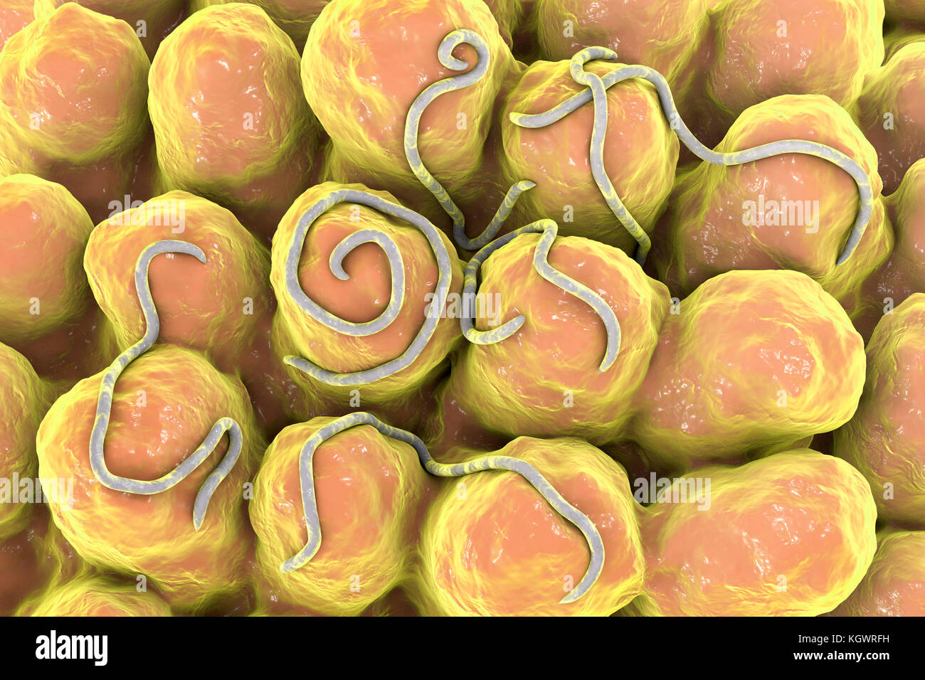Threadworms in the gut. Computer illustration showing multiple ...