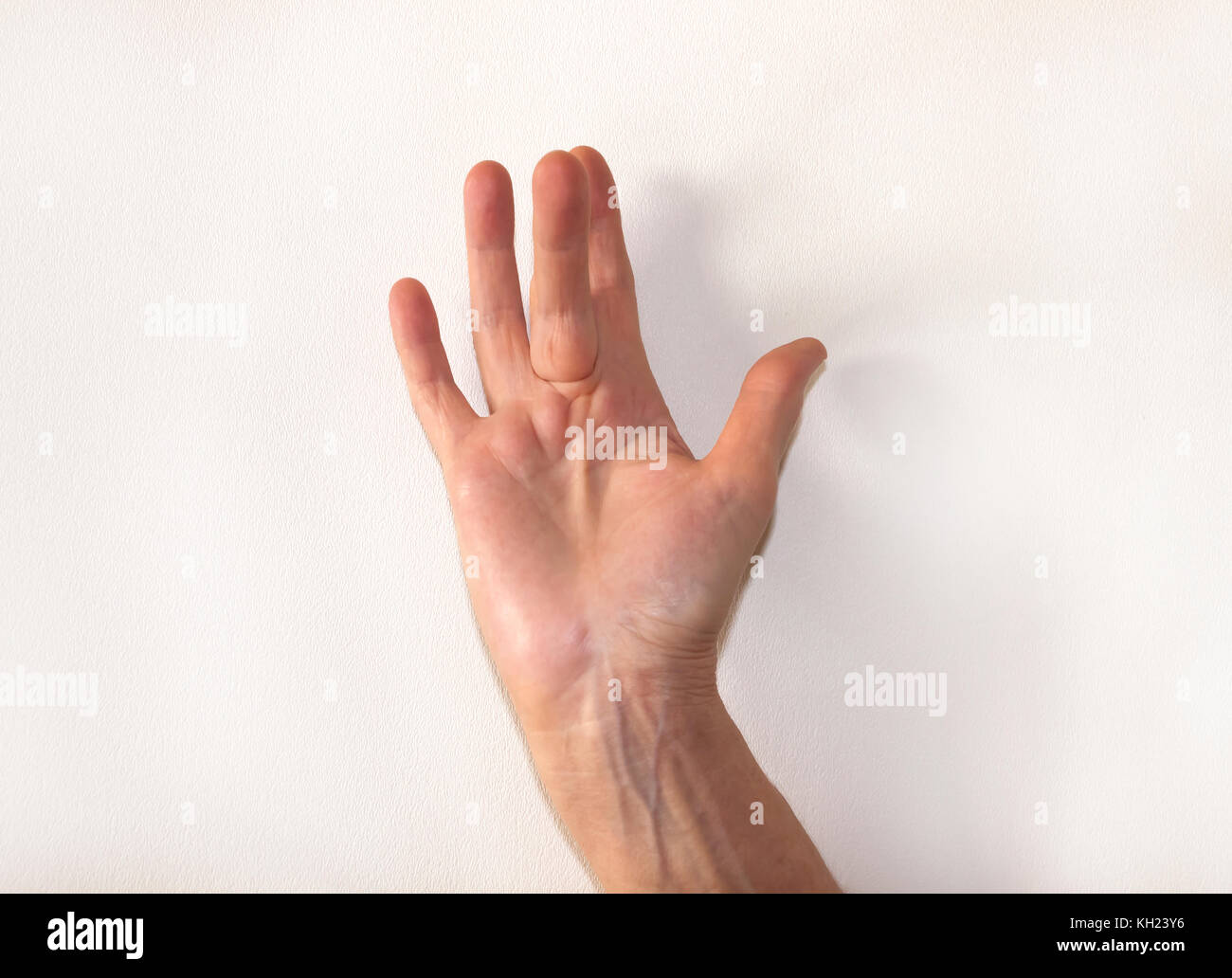 Dupuytrens Contracture High Resolution Stock Photography and Images - Alamy