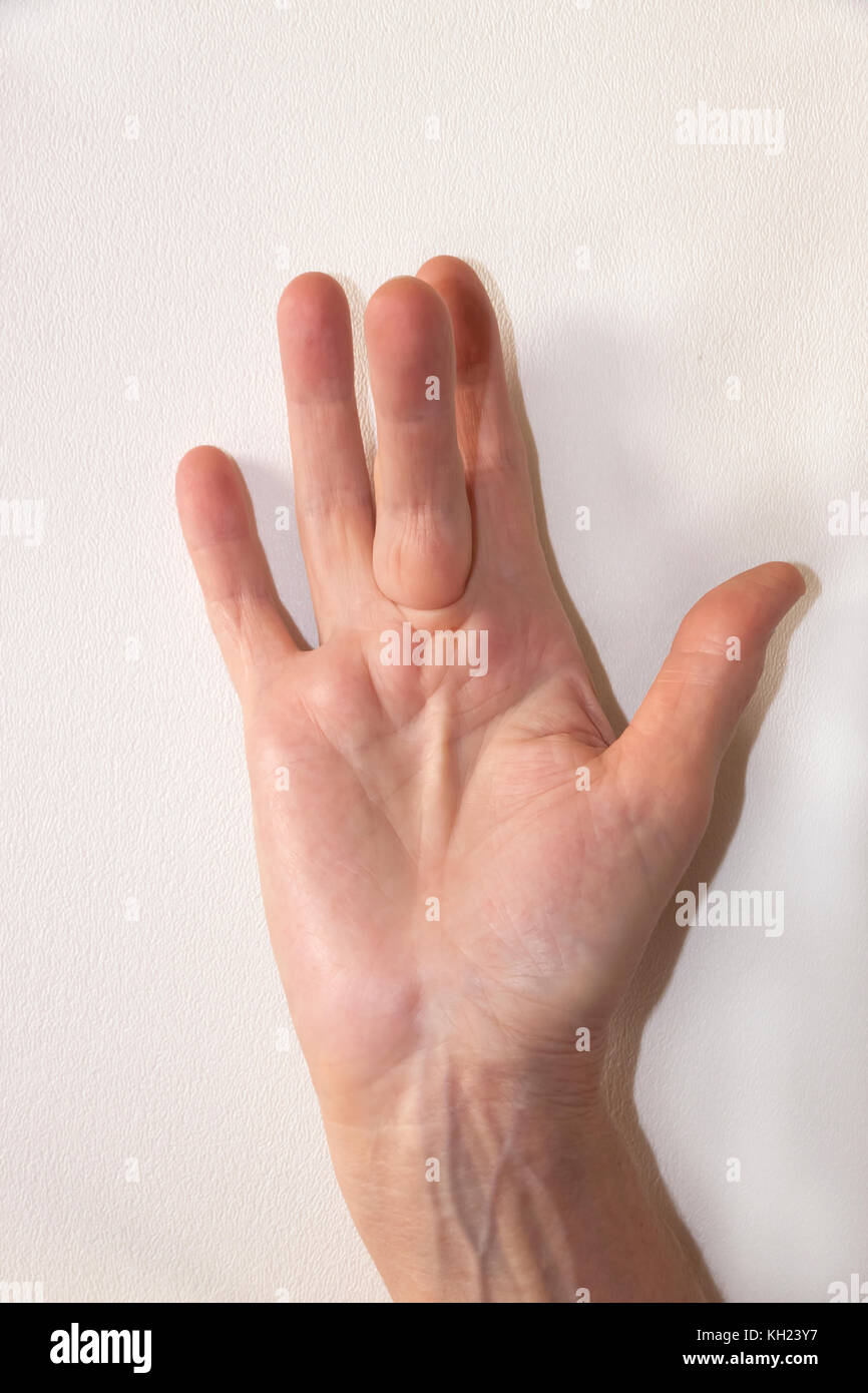 Dupuytren's Contracture deformity: a cord in the palm of hand (with a ...