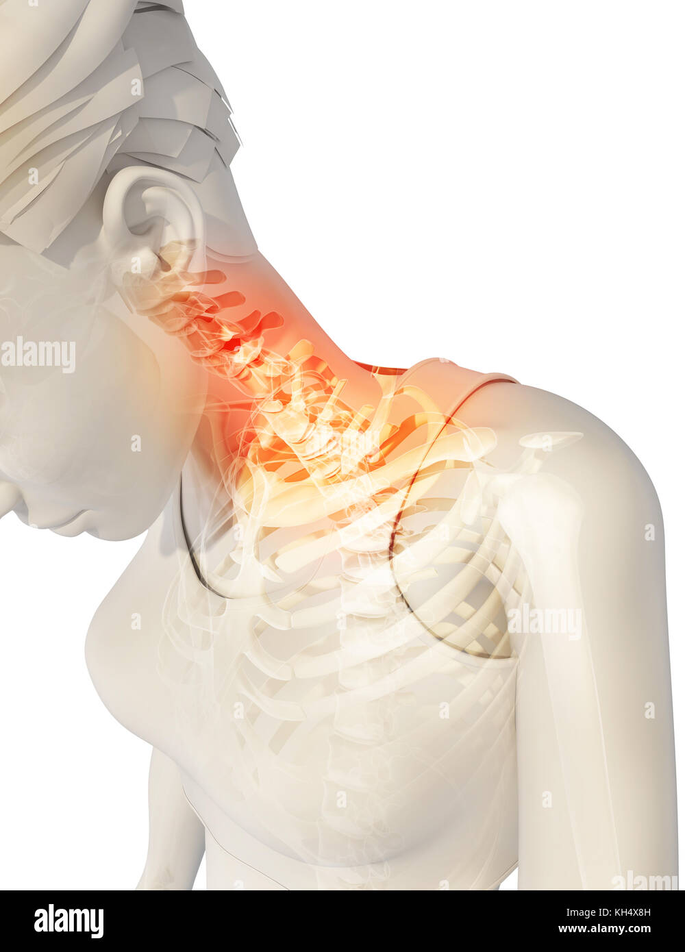 3D illustration, neck painful - cervical spine skeleton x-ray, medical ...