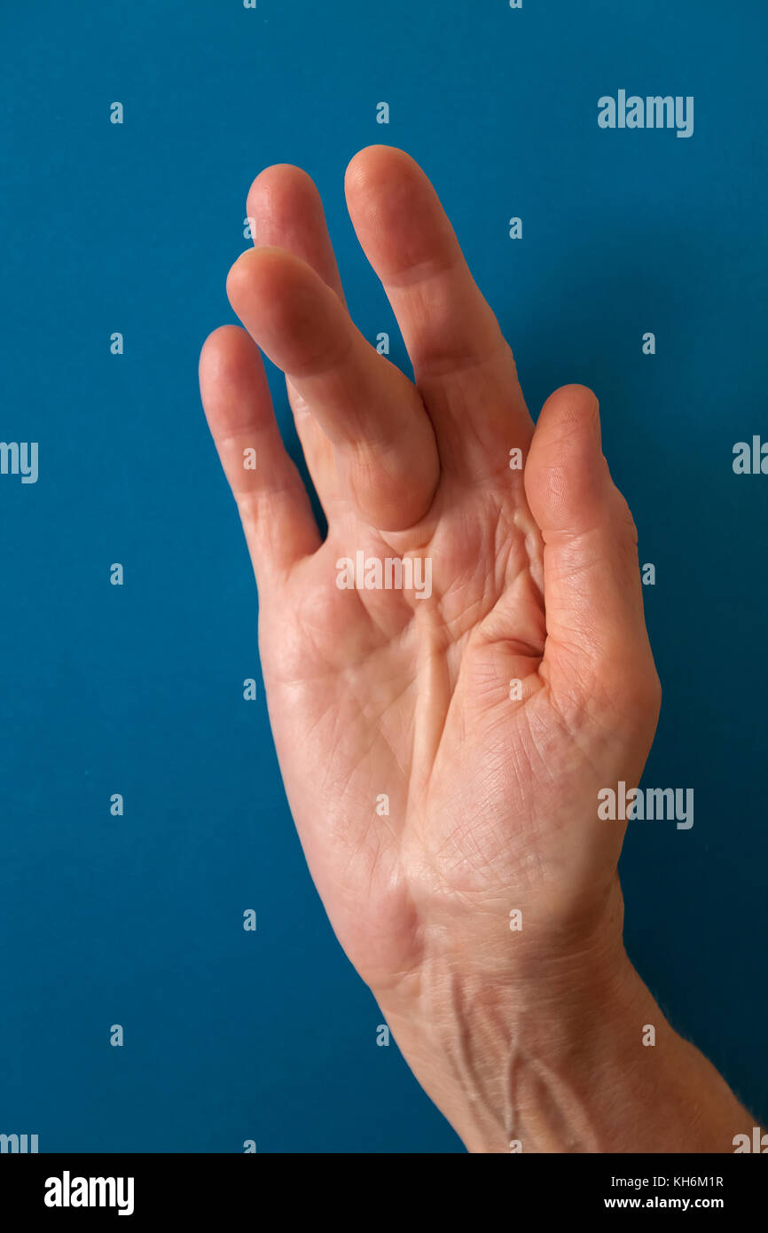 Flexion contracture hi-res stock photography and images - Alamy