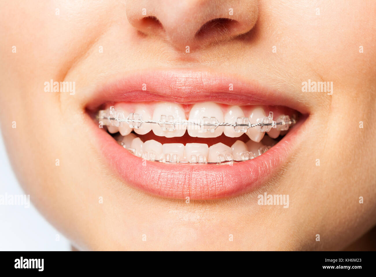 Close-up picture of healthy smile woman with clear brackets Stock Photo ...