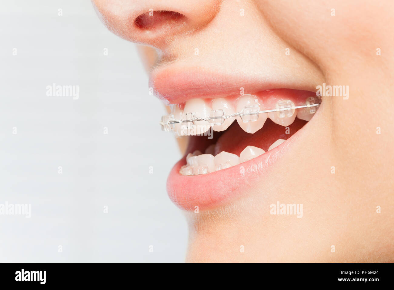 Side view picture of woman's smile with clear dental braces on teeth ...