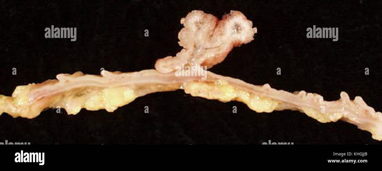 Adenomatous Polyp of the Colon 2 Stock Photo - Alamy