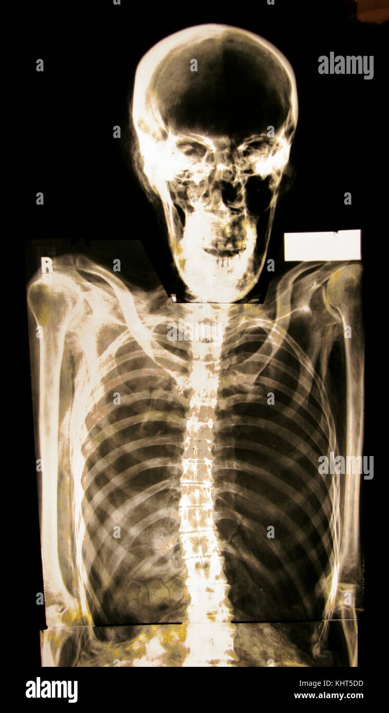 X-ray of Mummy Stock Photo - Alamy
