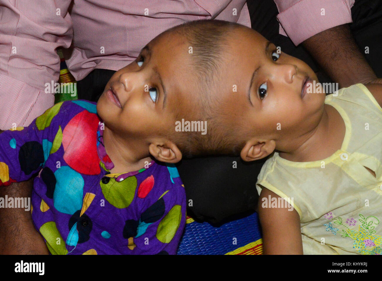 Siamese Twins Head Attached
