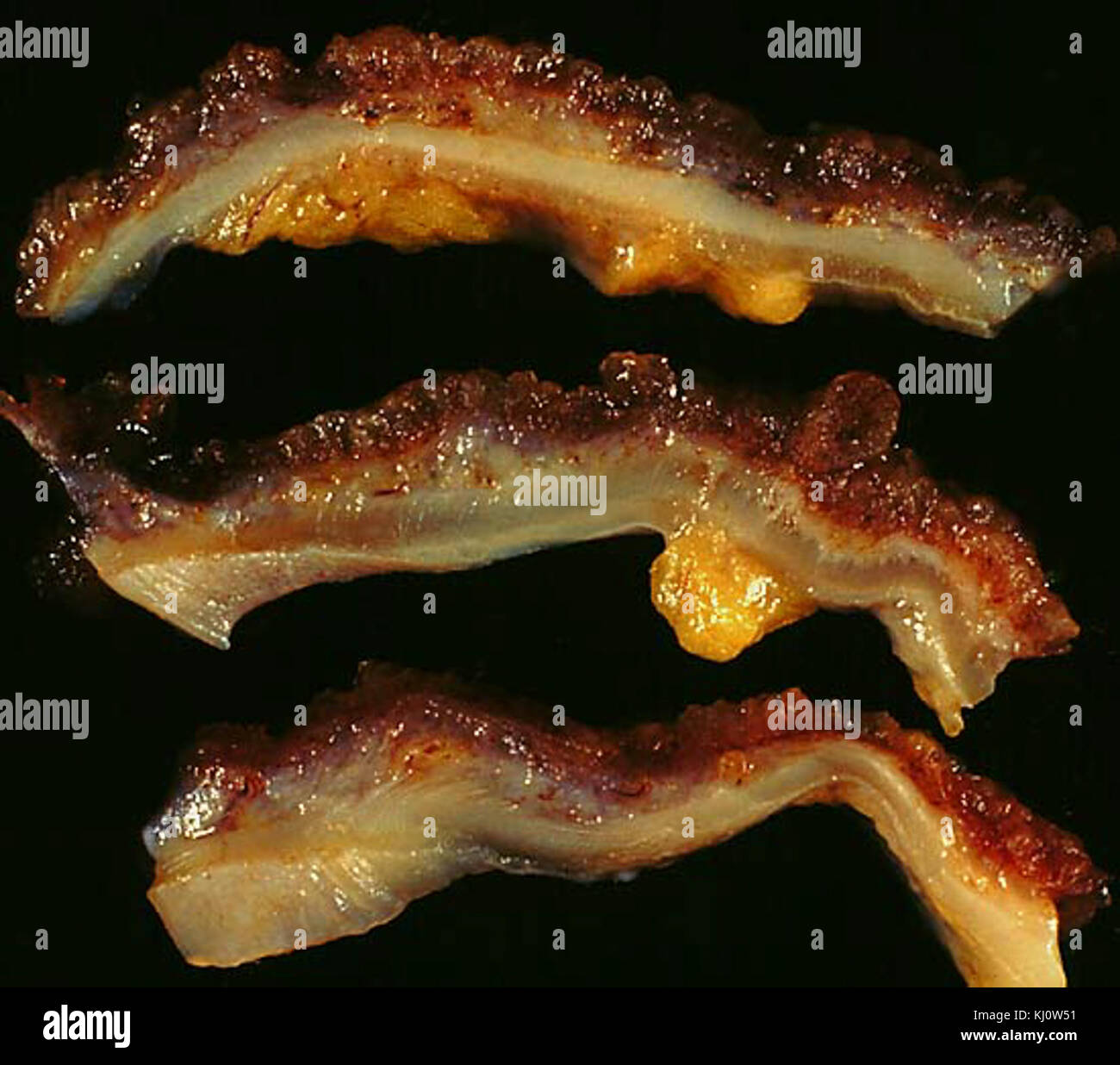 Chronic Ulcerative Colitis 2 Stock Photo - Alamy