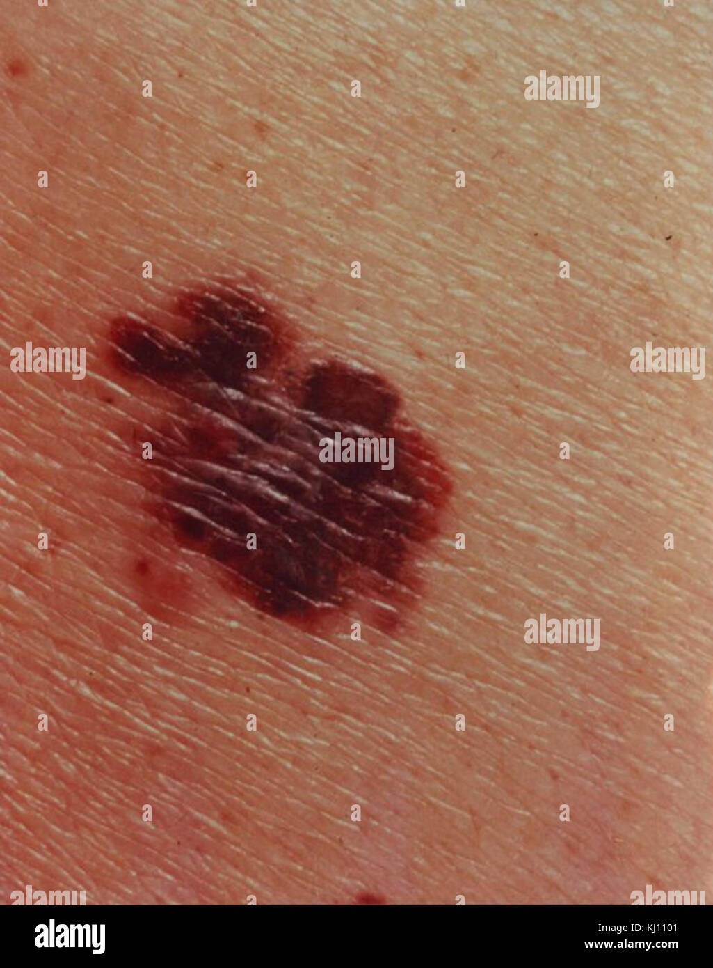 Melanoma, brown and red lesion 1 Stock Photo - Alamy