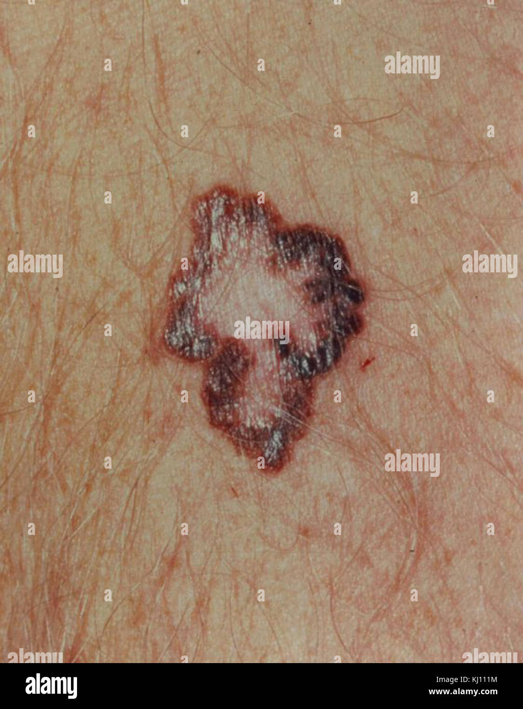 Melanoma, brown lesion Stock Photo - Alamy