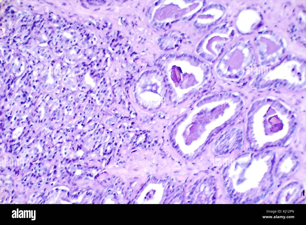 Prostate cancer refers to a form of cancer that develops in the ...