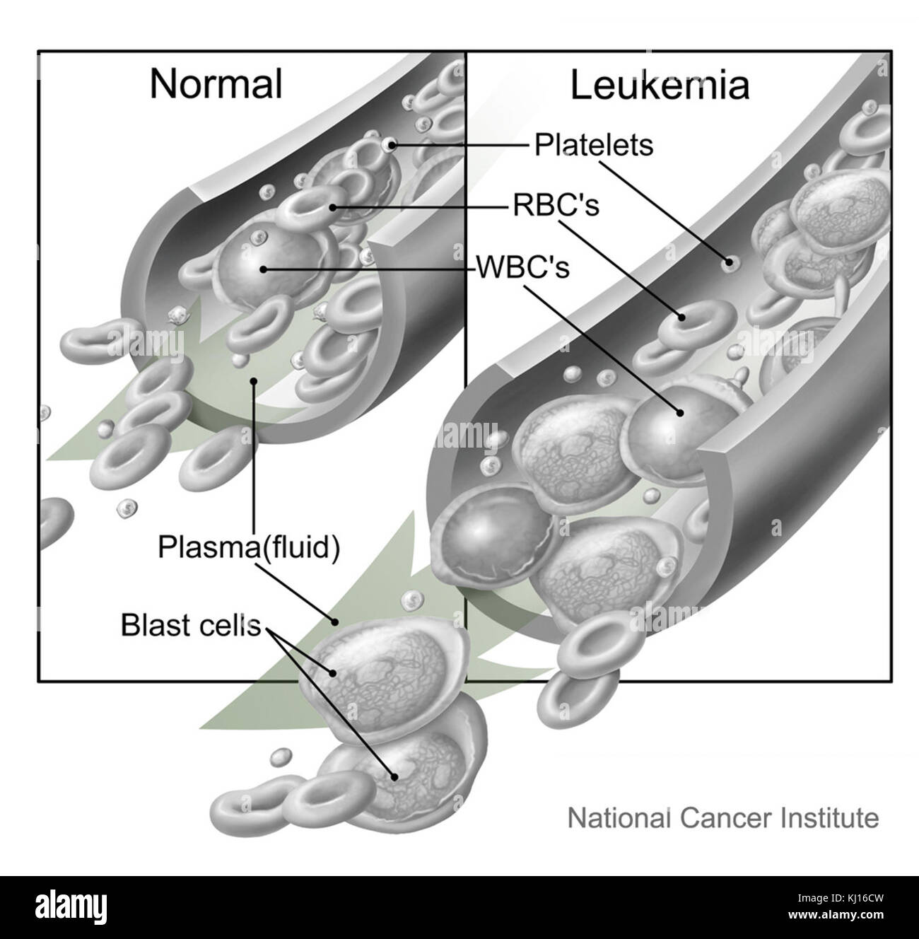 Blood cells (normal and leukemia Stock Photo - Alamy