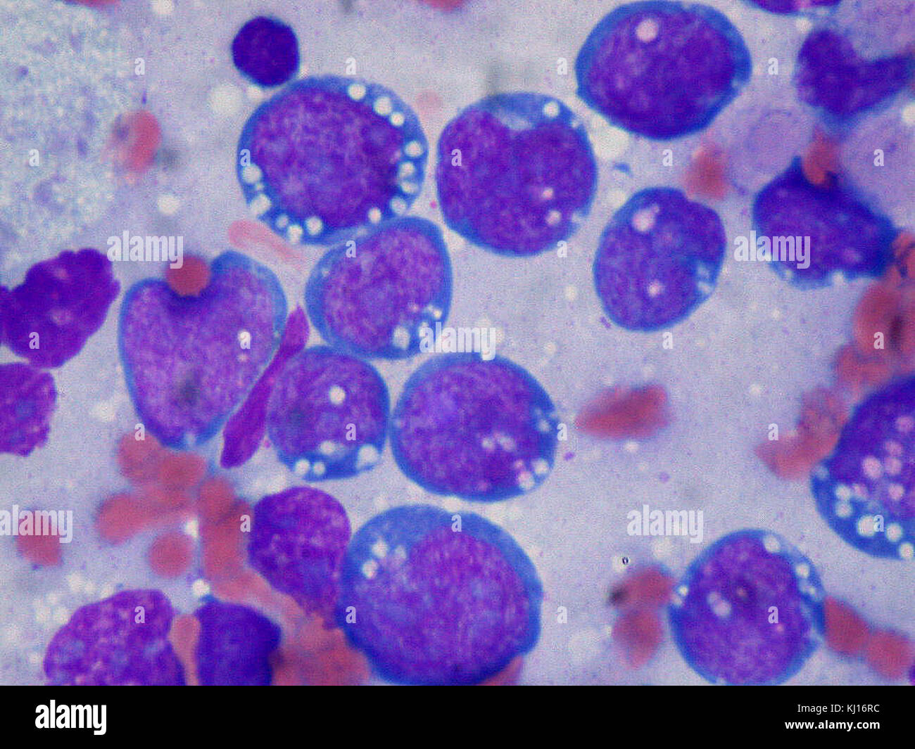Burkitt lymphoma, touch prep, Wright stain Stock Photo - Alamy
