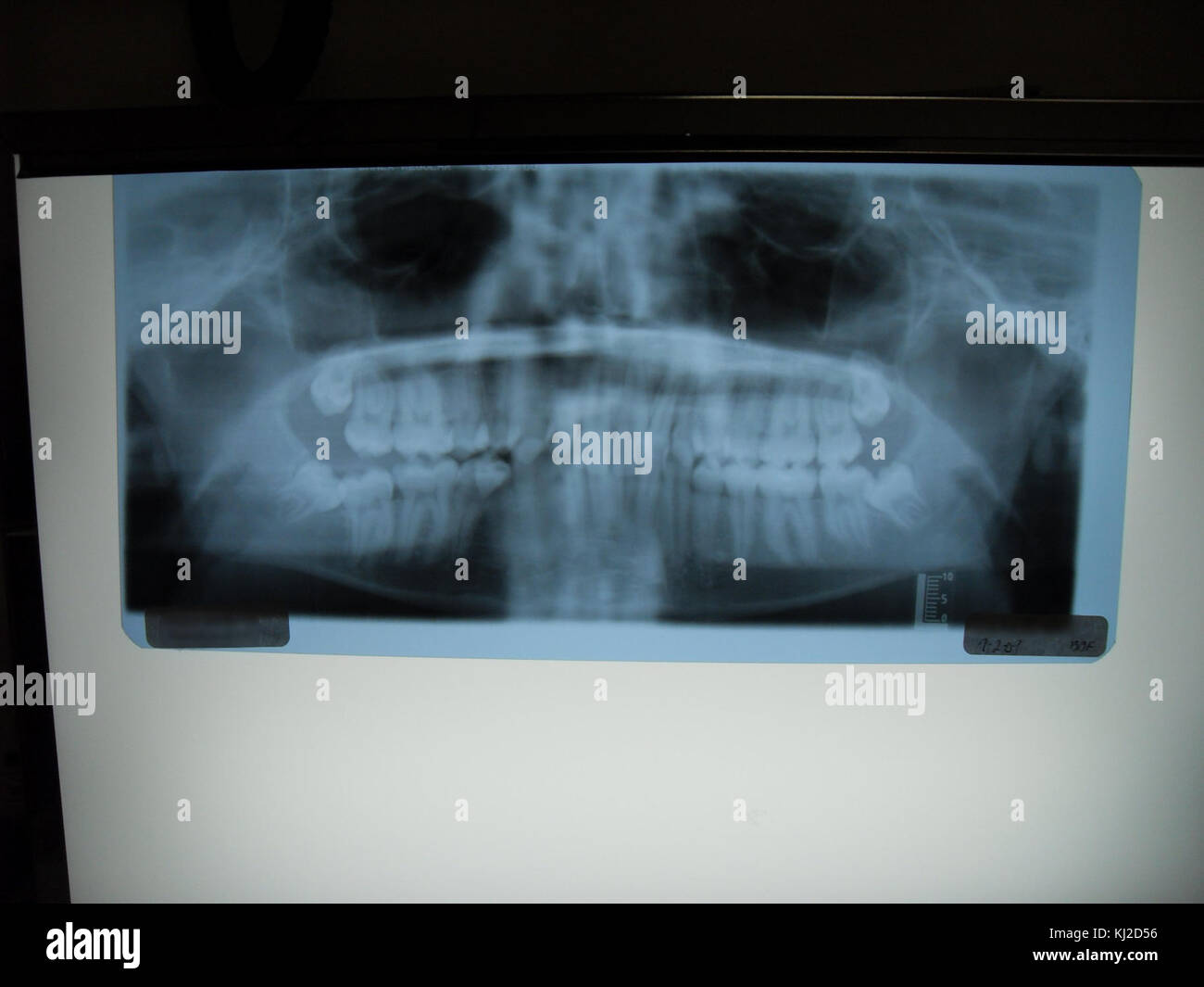 Impacted teeth hi-res stock photography and images - Alamy