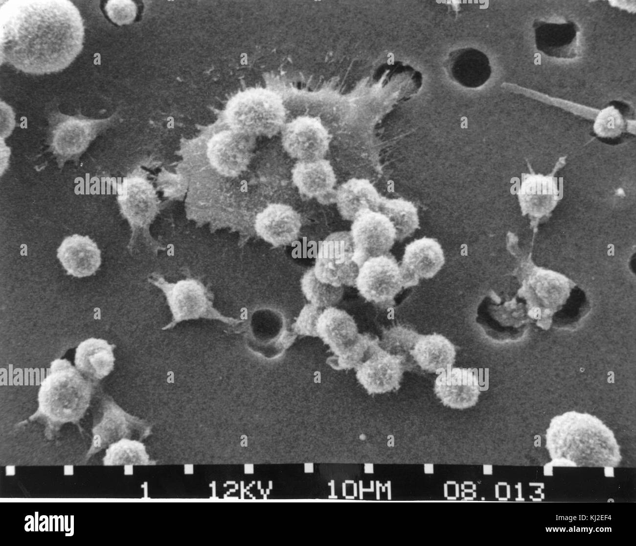 Cancer cells- death (step 2 Stock Photo - Alamy