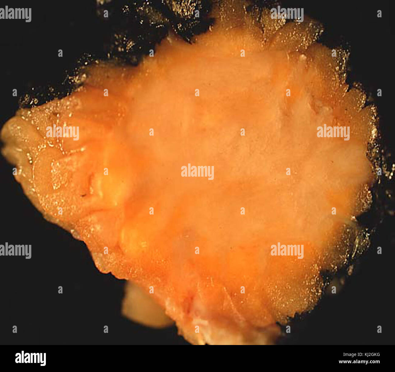 Granular cell hi-res stock photography and images - Alamy