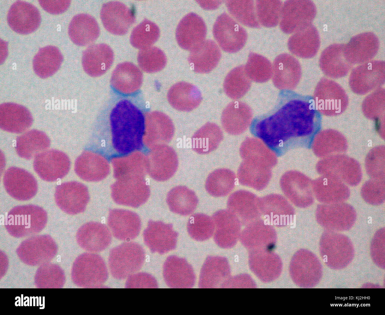 Infectious mononucleosis hi-res stock photography and images - Alamy