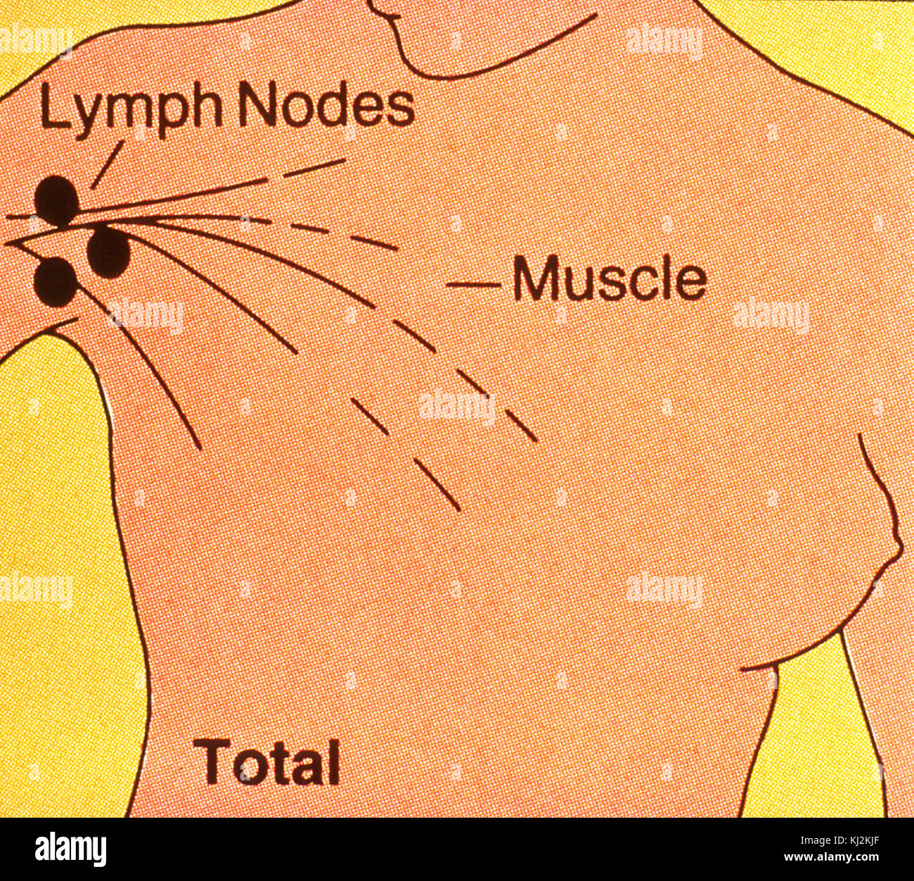 Simple mastectomy hi-res stock photography and images - Alamy