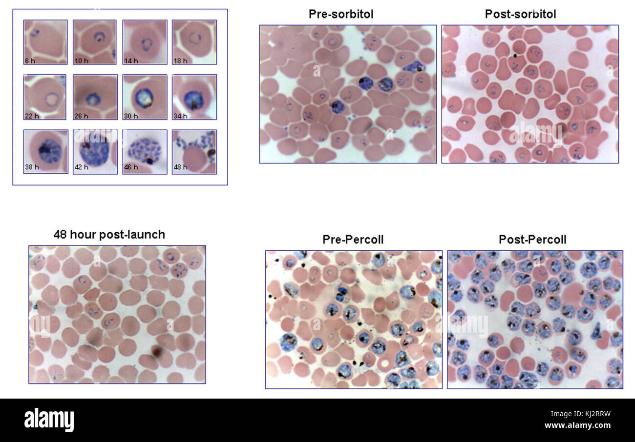 Blood stages of P. falciparum Stock Photo - Alamy