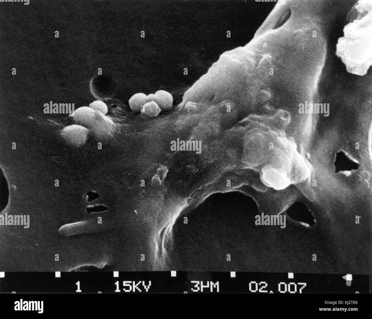 Cancer cells- death (step 4 Stock Photo - Alamy