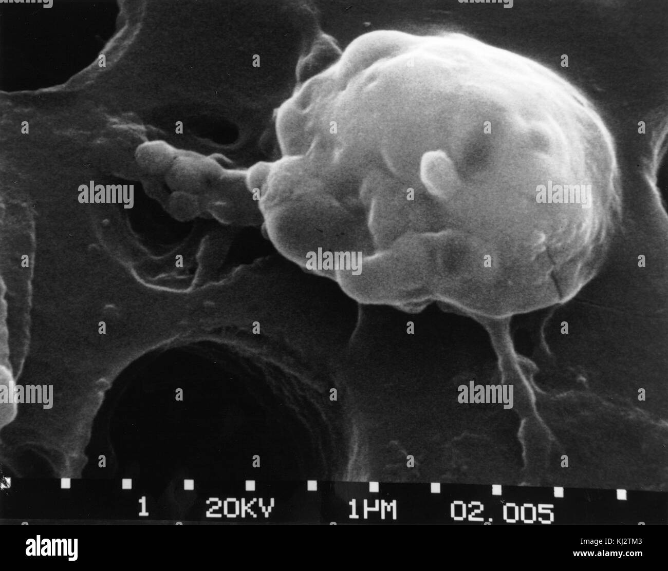 Cancer cells- death (step 5 Stock Photo - Alamy