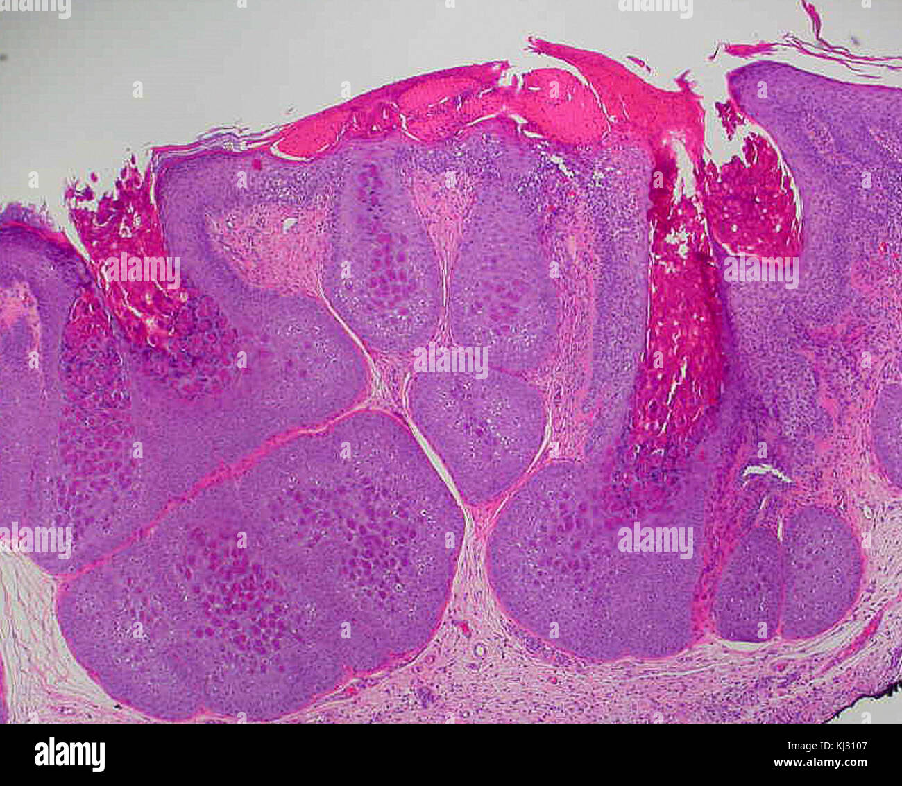 Molluscum Contagiosum 1 Stock Photo - Alamy