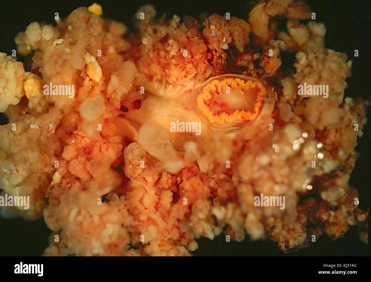 Serous papillary hi-res stock photography and images - Alamy