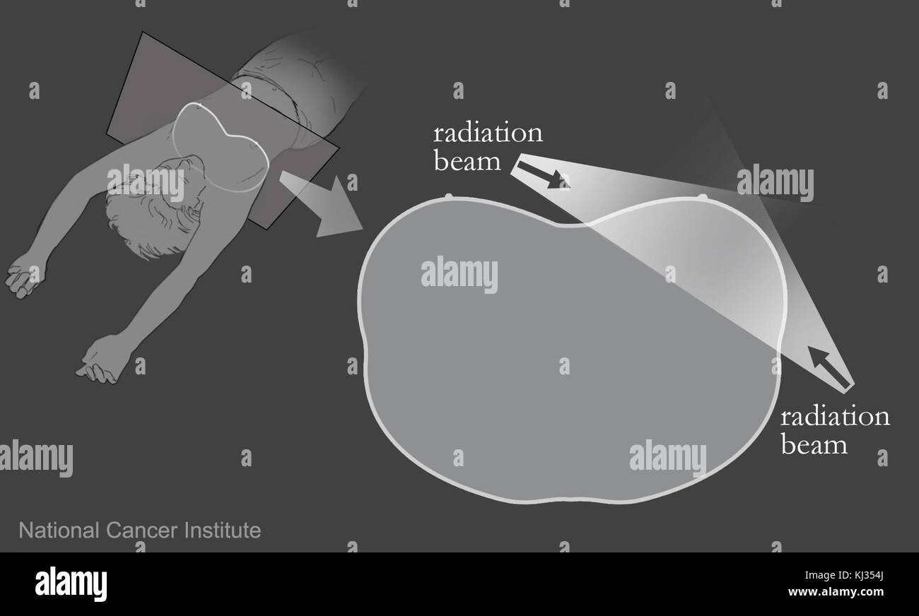Therapeutic beam hi-res stock photography and images - Alamy