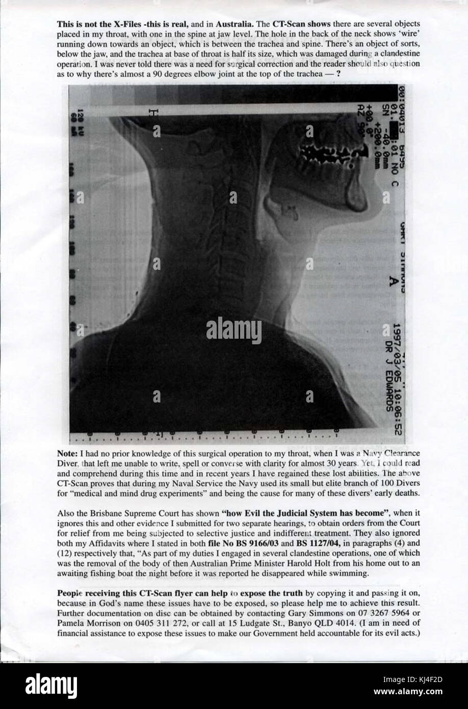 Gary Simmons' CT scan Stock Photo - Alamy