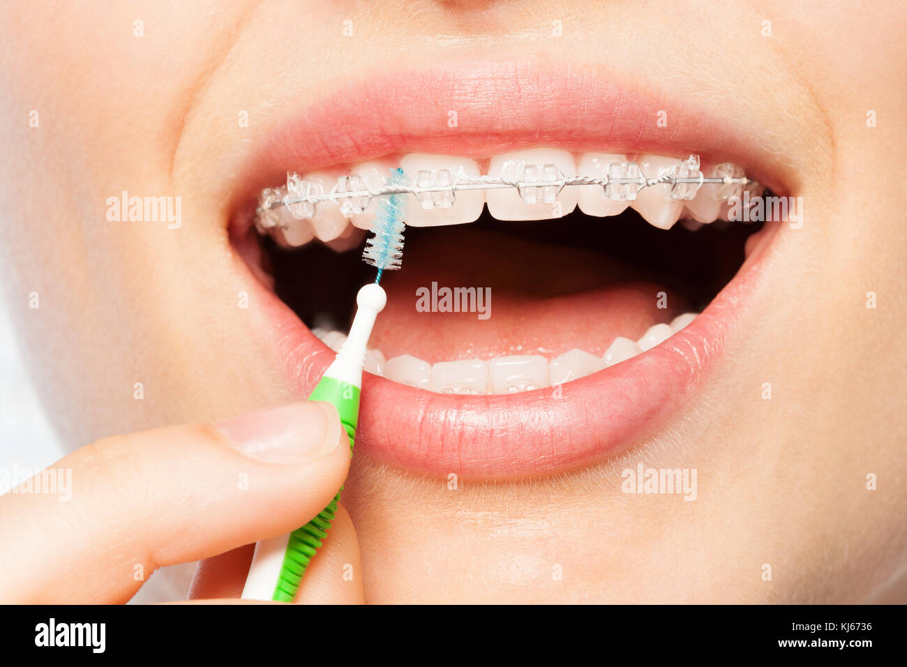 Female mouth with dental braces and interdental brush Stock Photo - Alamy