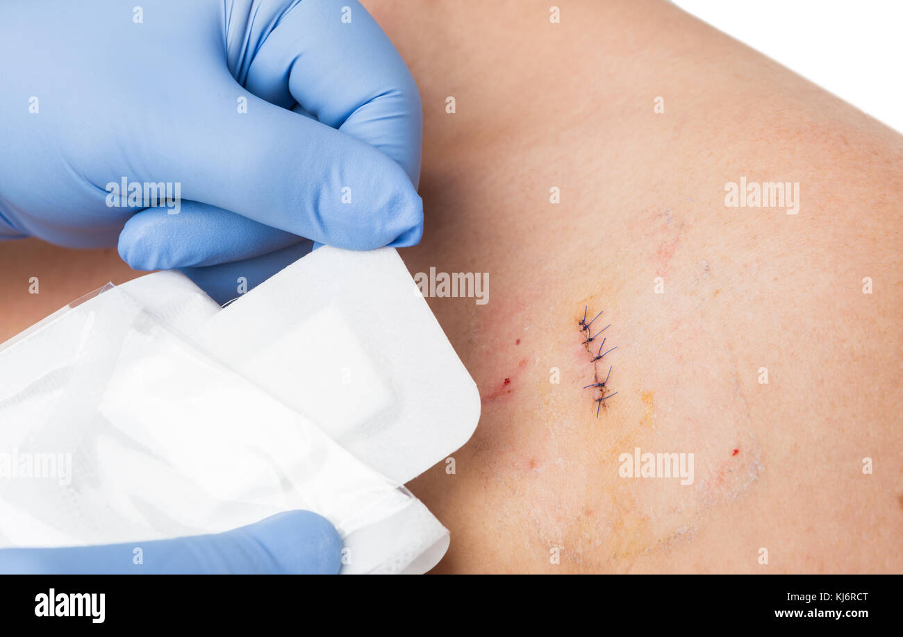 Surgery shoulder incision hi-res stock photography and images - Alamy