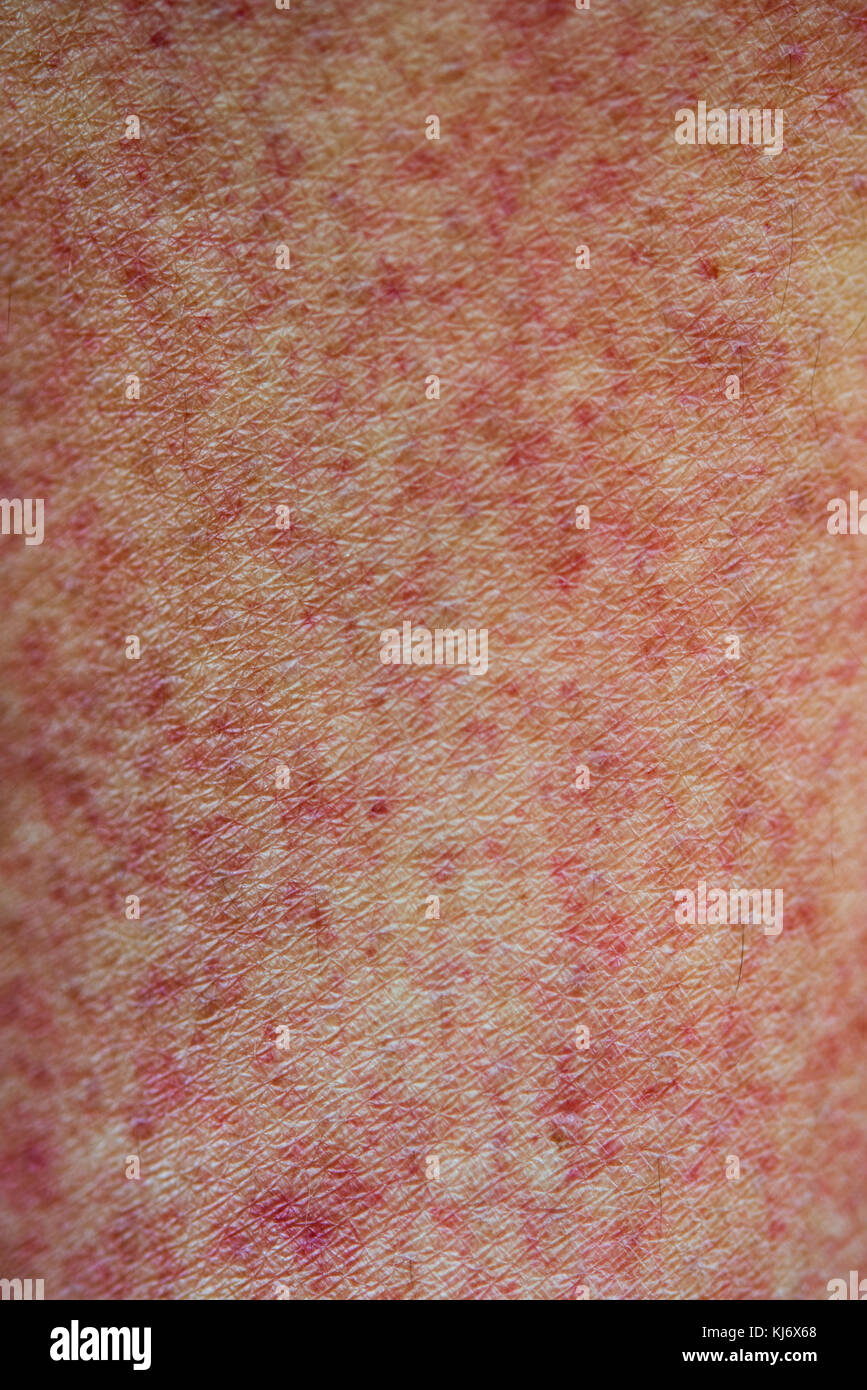 Close up human skin with red rashes, or dengue fever Stock Photo - Alamy