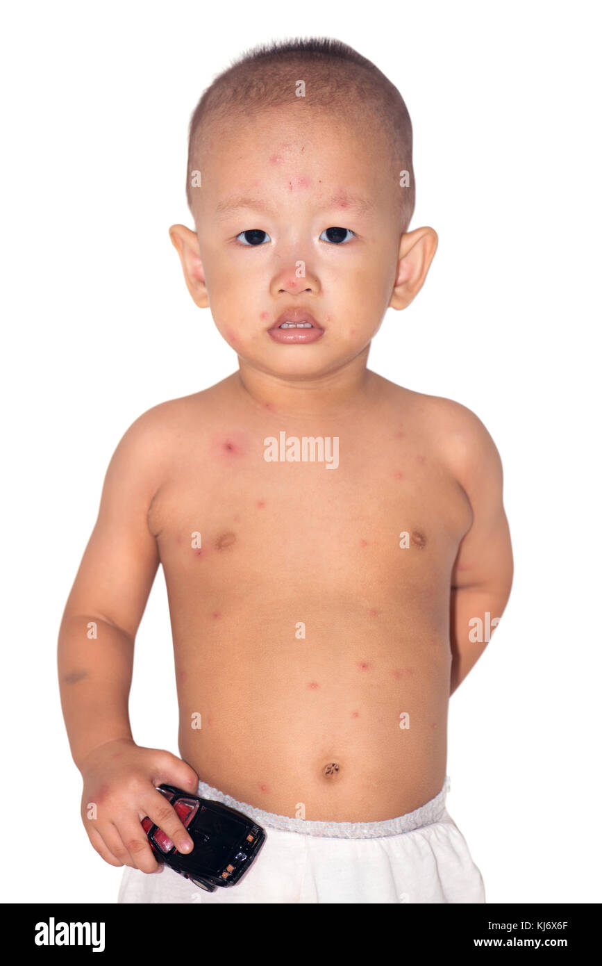 Twenty months old baby boy with chicken pox, standing isolated on white ...